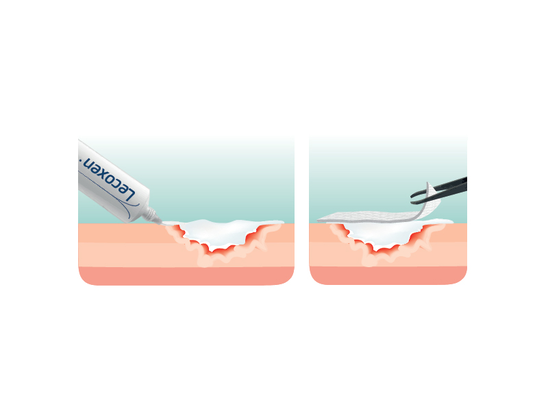 CREAM-DIRECTIONS | LECOXEN®